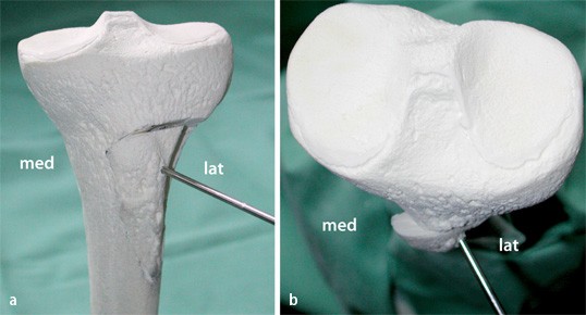 Anteromedialisierung der Tuberositas tibiae | SpringerLink