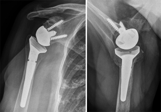 Inverse Schulterprothese – Indikation, Operationstechnik und Ergebnisse ...