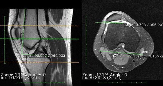Trochleaplastik bei patellofemoraler Instabilität | SpringerLink