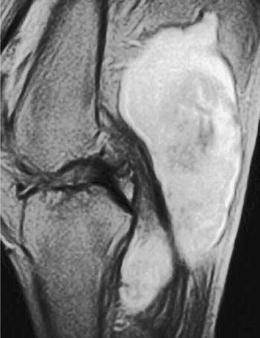 The popliteal cyst | SpringerLink