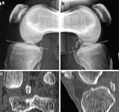 Screw fixation of a 4 1/2-year-old PCL avulsion injury | SpringerLink