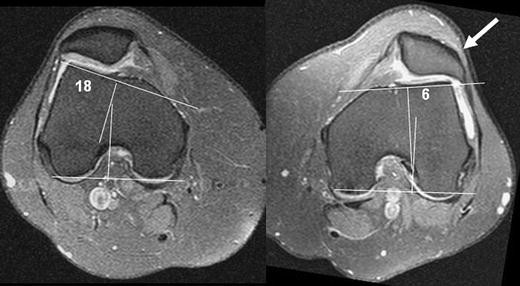 Is there a relationship between anterior knee pain and femoral ...