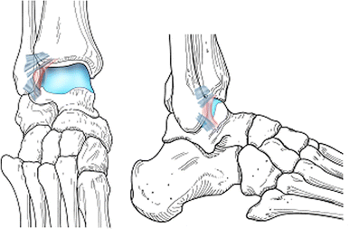 The anterior tibio-talar ligament: one reason for anterior ankle ...