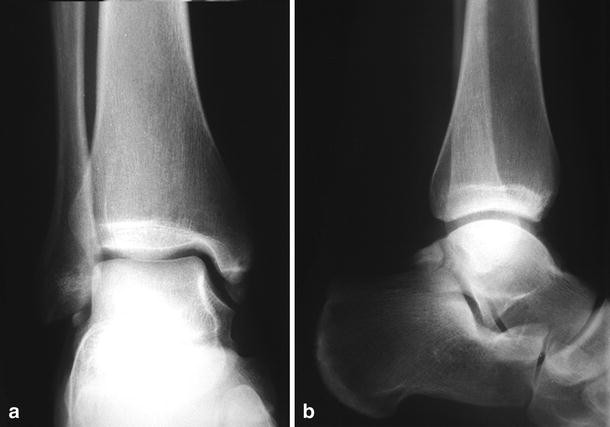 True submalleolar accessory ossicles causing impingement of the ankle ...
