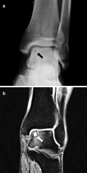 Arthroscopic microfracture for osteochondral lesions of the talus ...