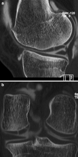 Epidemiology and imaging of the subchondral bone in articular cartilage ...
