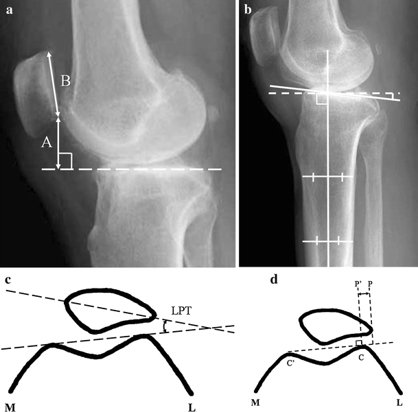 Opening wedge high tibial osteotomy affects both the lateral patellar ...