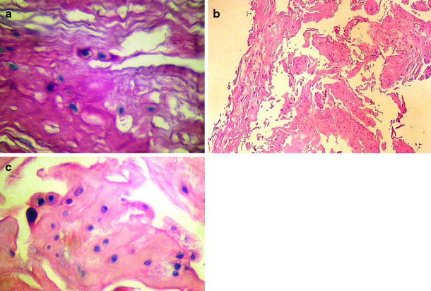 Mucoid degeneration of the anterior cruciate ligament: MRI, clinical ...
