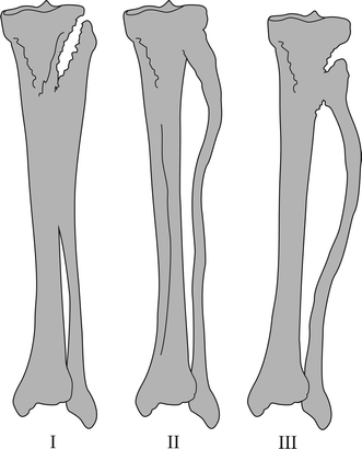 Proximal tibiofibular synostosis as a possible cause of a ...
