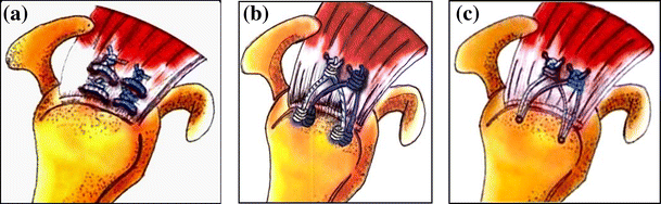 Contact area and pressure in suture bridge rotator cuff repair using ...