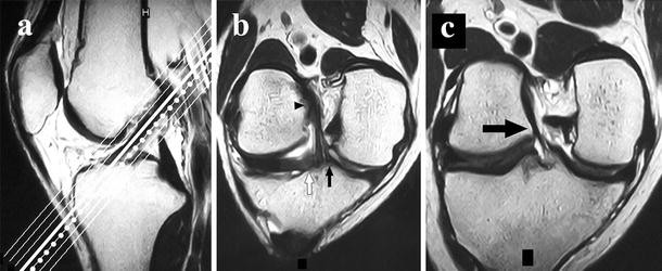 MRI analysis of the attachment of the anteromedial and posterolateral ...