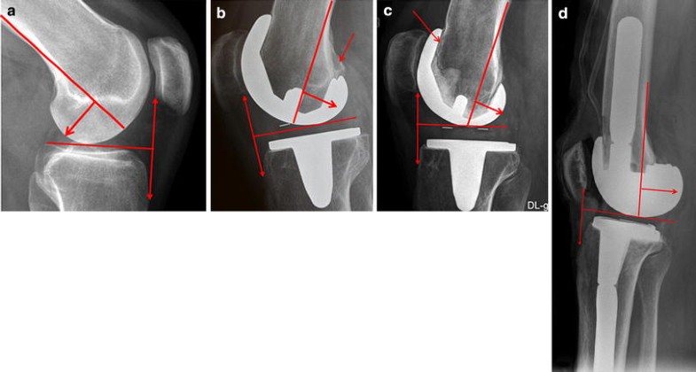 The painful knee after TKA: a diagnostic algorithm for failure analysis ...