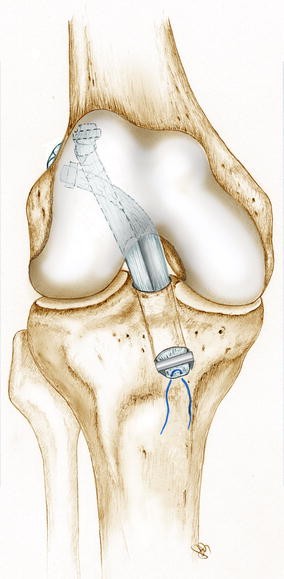 Over-the-top double-bundle revision ACL reconstruction | SpringerLink
