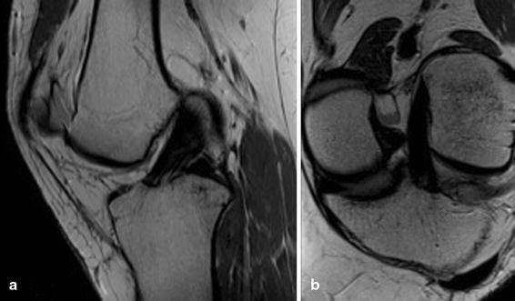 How to optimize the use of MRI in anatomic ACL reconstruction ...