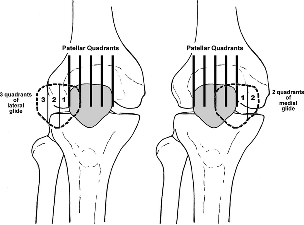 Patella instability: building bridges across the ocean a historic ...