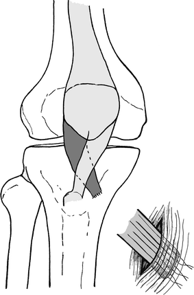 Patella instability: building bridges across the ocean a historic ...