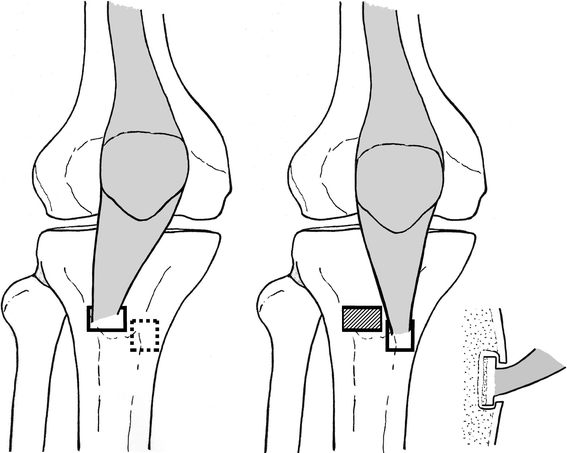 Patella instability: building bridges across the ocean a historic ...