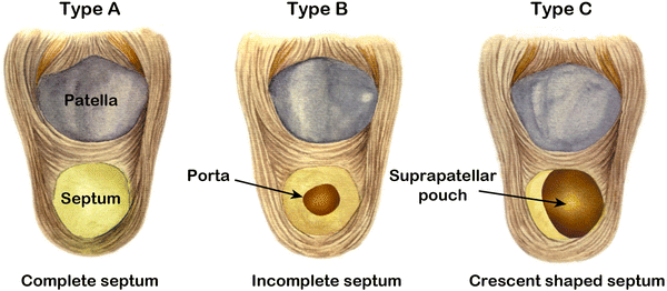 ‘The Sneaky Plica’ revisited: morphology, pathophysiology and treatment ...