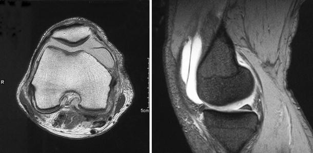 ‘The Sneaky Plica’ revisited: morphology, pathophysiology and treatment ...
