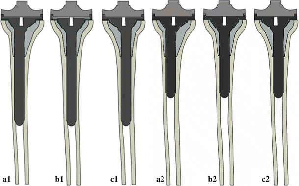 Biomechanical analysis of the tibial tray design in TKA: comparison ...