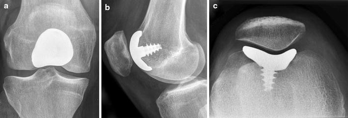 Prospective evaluation of anatomic patellofemoral inlay resurfacing ...