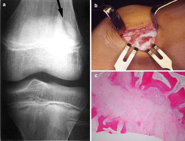 Developmental anomaly of ossification type patella partita | SpringerLink