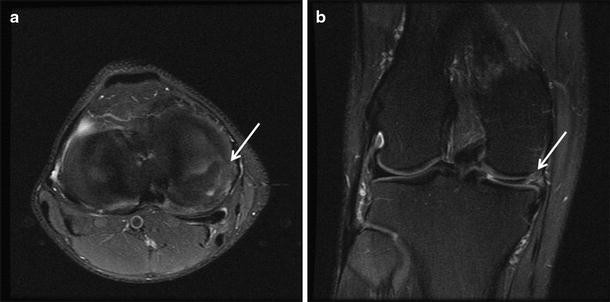 Repair of a complete radial tear in the midbody of the medial meniscus ...