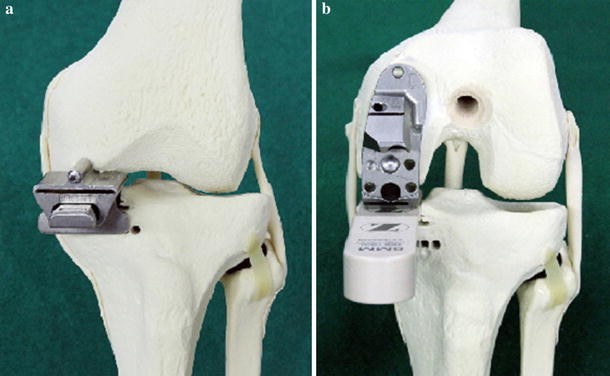 The coronal alignment after medial unicompartmental knee arthroplasty ...