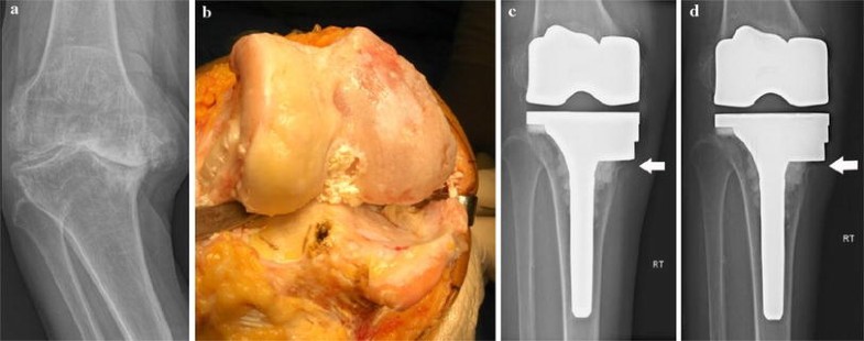 Double metal tibial blocks augmentation in total knee arthroplasty ...