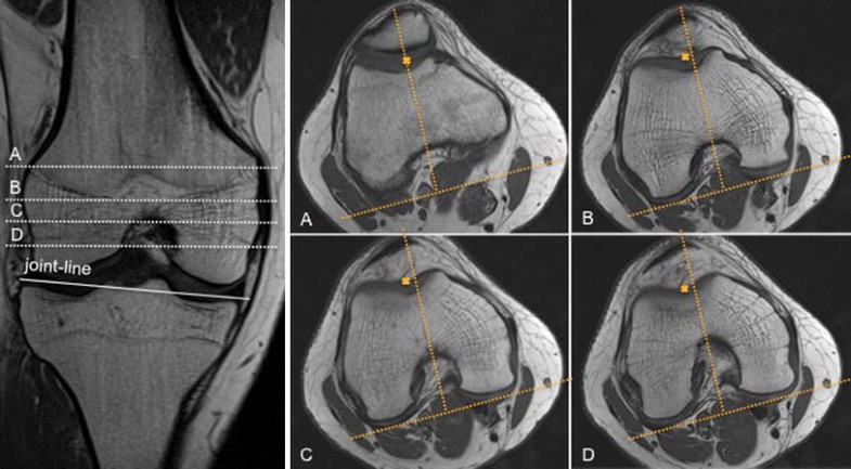 The tibial–tubercle trochlear groove distance in patients with ...