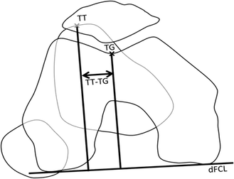 The contribution of the tibial tubercle to patellar instability ...