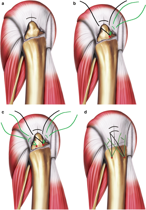 Arthroscopic modified Mason-Allen technique for large U- or L-shaped ...