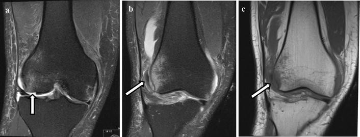 Bone marrow lesions and subchondral bone pathology of the knee ...