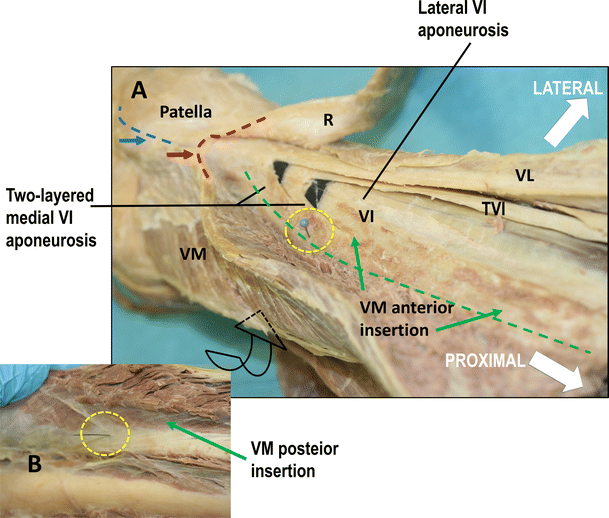 The interaction between the vastus medialis and vastus intermedius and ...