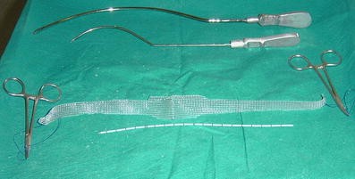 The use of polypropylene mesh as a transobturator sling for the ...