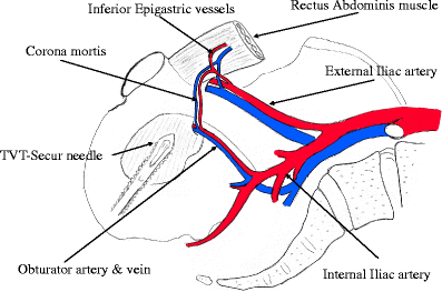 A serious bleeding complication with injury of the corona mortis with ...