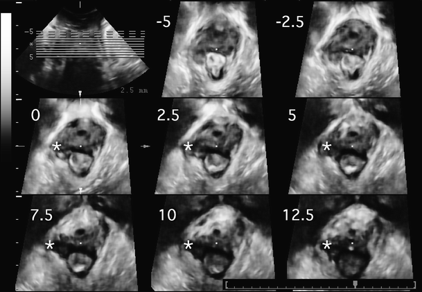Minimal criteria for the diagnosis of avulsion of the puborectalis ...