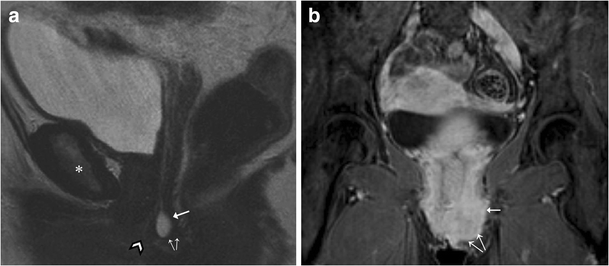 MRI of female urethra and periurethral pathologies | SpringerLink