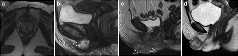 MRI of female urethra and periurethral pathologies | SpringerLink