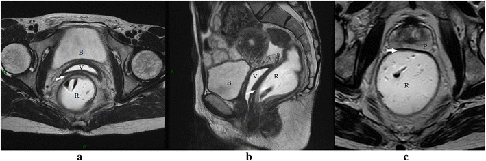 Concepts of the rectovaginal septum: implications for function and ...