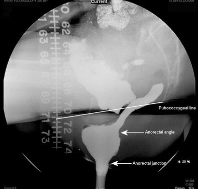 Descending perineum syndrome: a review of the presentation, diagnosis ...