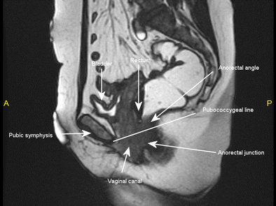 Descending perineum syndrome: a review of the presentation, diagnosis ...