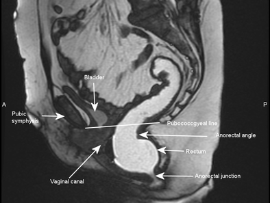 Descending perineum syndrome: a review of the presentation, diagnosis ...