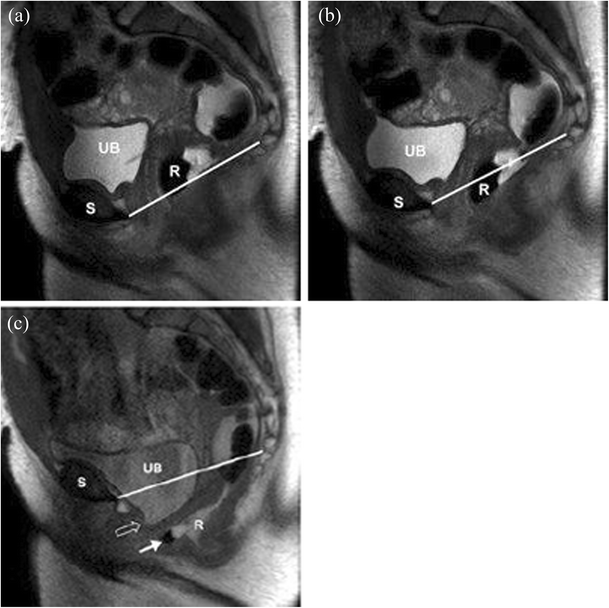 Dynamic 3T pelvic floor magnetic resonance imaging in women progressing ...