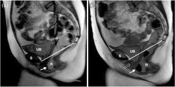 Dynamic 3T pelvic floor magnetic resonance imaging in women progressing ...
