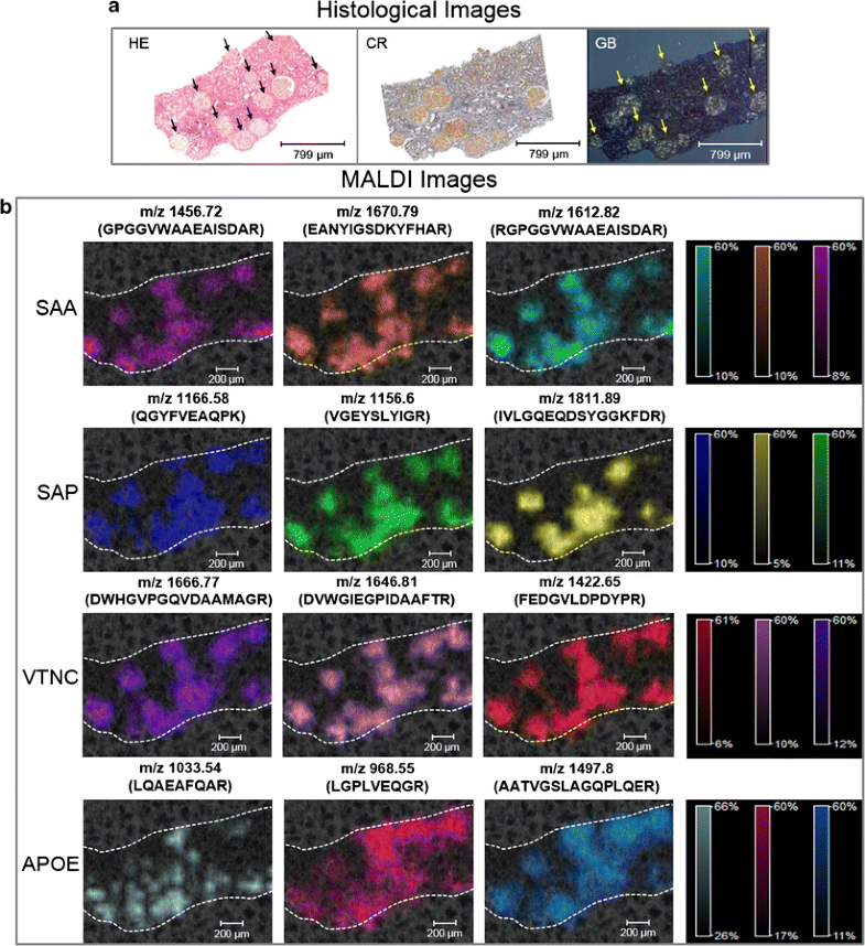 Imaging mass spectrometry analysis of renal amyloidosis biopsies ...