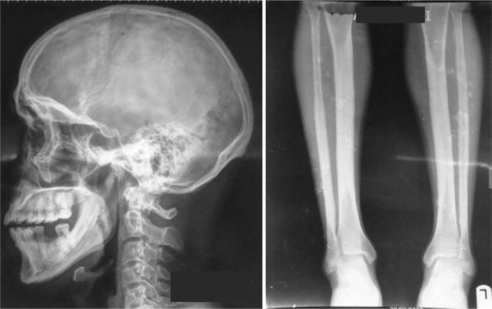 Camurati–Engelmann Disease (Progressive Diaphyseal Dysplasia): Reports ...