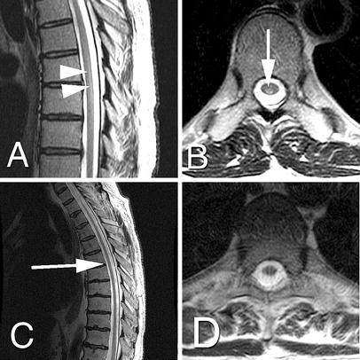 Imaging features of copper deficiency myelopathy: a study of 25 cases ...