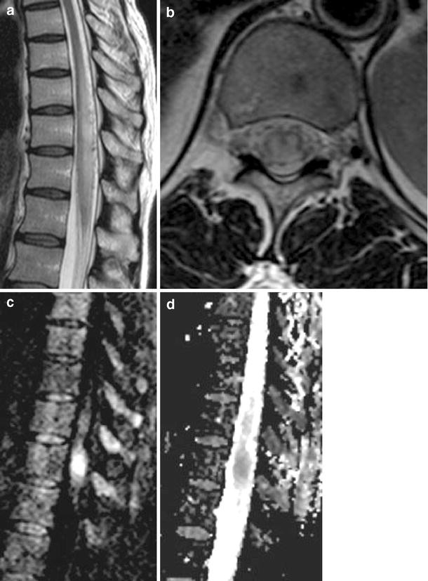 Diffusion-weighted MR imaging (DWI) in spinal cord ischemia | SpringerLink