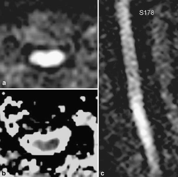 Diffusion-weighted MR imaging (DWI) in spinal cord ischemia | SpringerLink